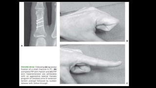 Phalangeal fractures of hand | PPTX