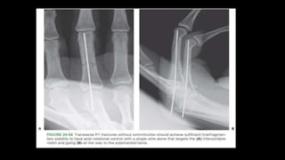 Phalangeal fractures of hand | PPTX