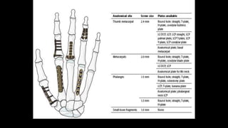 Phalangeal fractures of hand | PPTX
