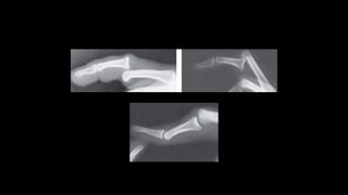 Phalangeal fractures of hand | PPTX