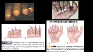 Phalangeal fractures of hand | PPTX