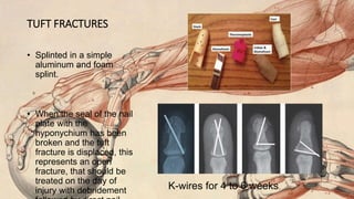 Phalangeal fractures of hand | PPT