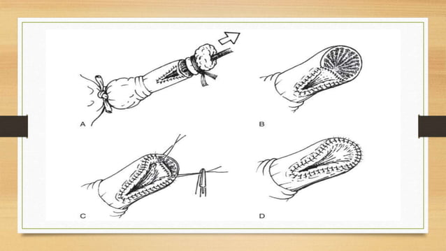 Phallectomy | PPTX | Surgery | Medical Health