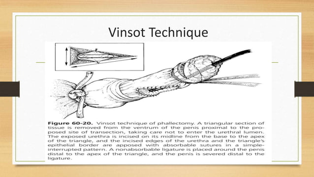 Phallectomy | PPTX | Surgery | Medical Health