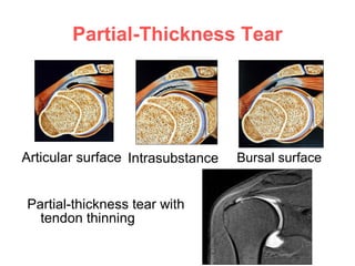 Phân độ tổn thương cơ xương khớp các chi | PPT