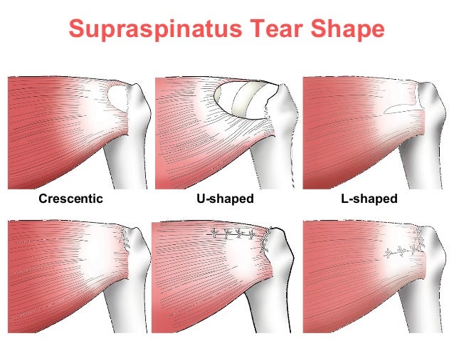 Phân độ tổn thương cơ xương khớp các chi