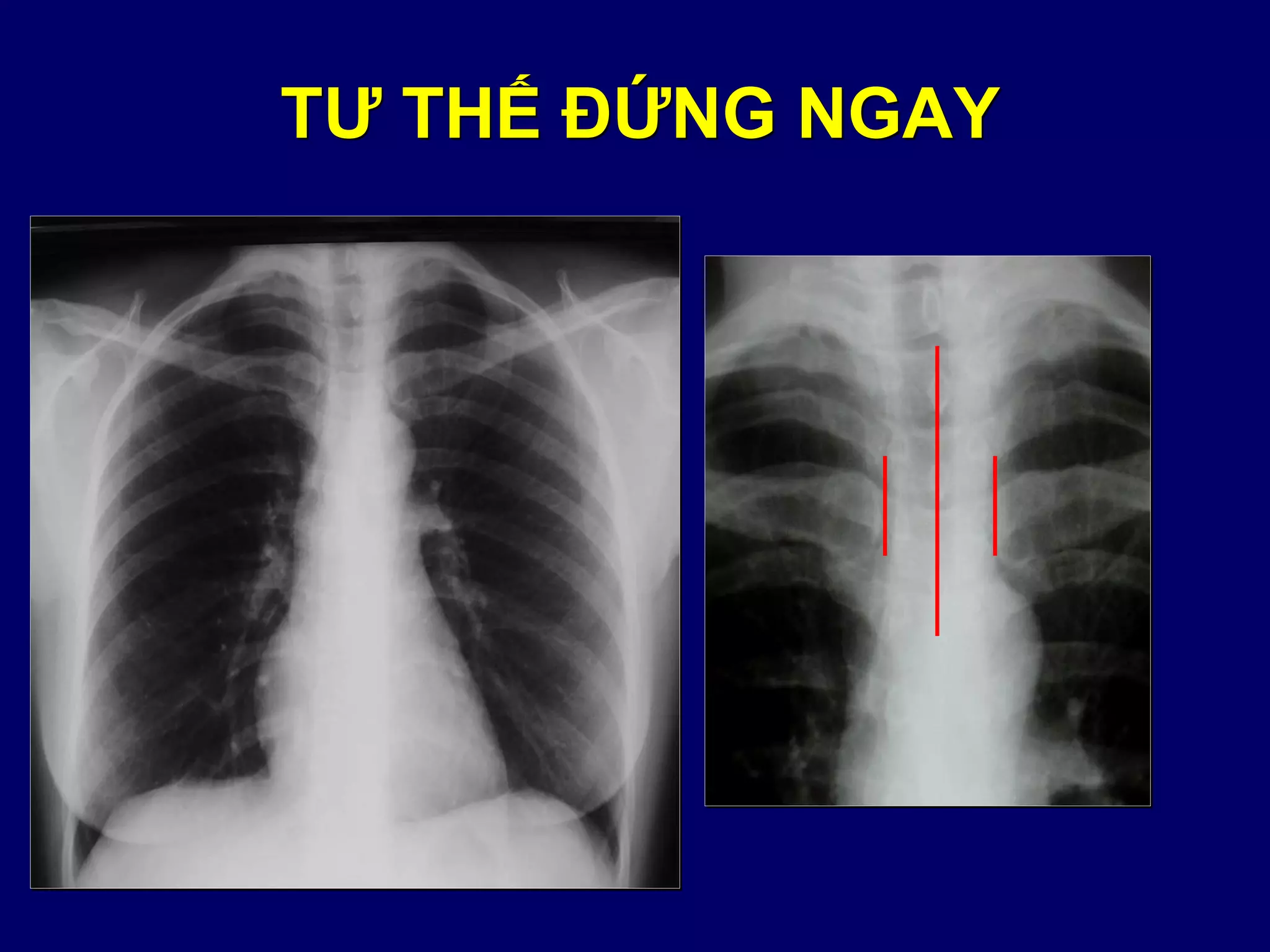 PHÂN TÍCH HÌNH ẢNH X QUANG LỒNG NGỰC | PDF