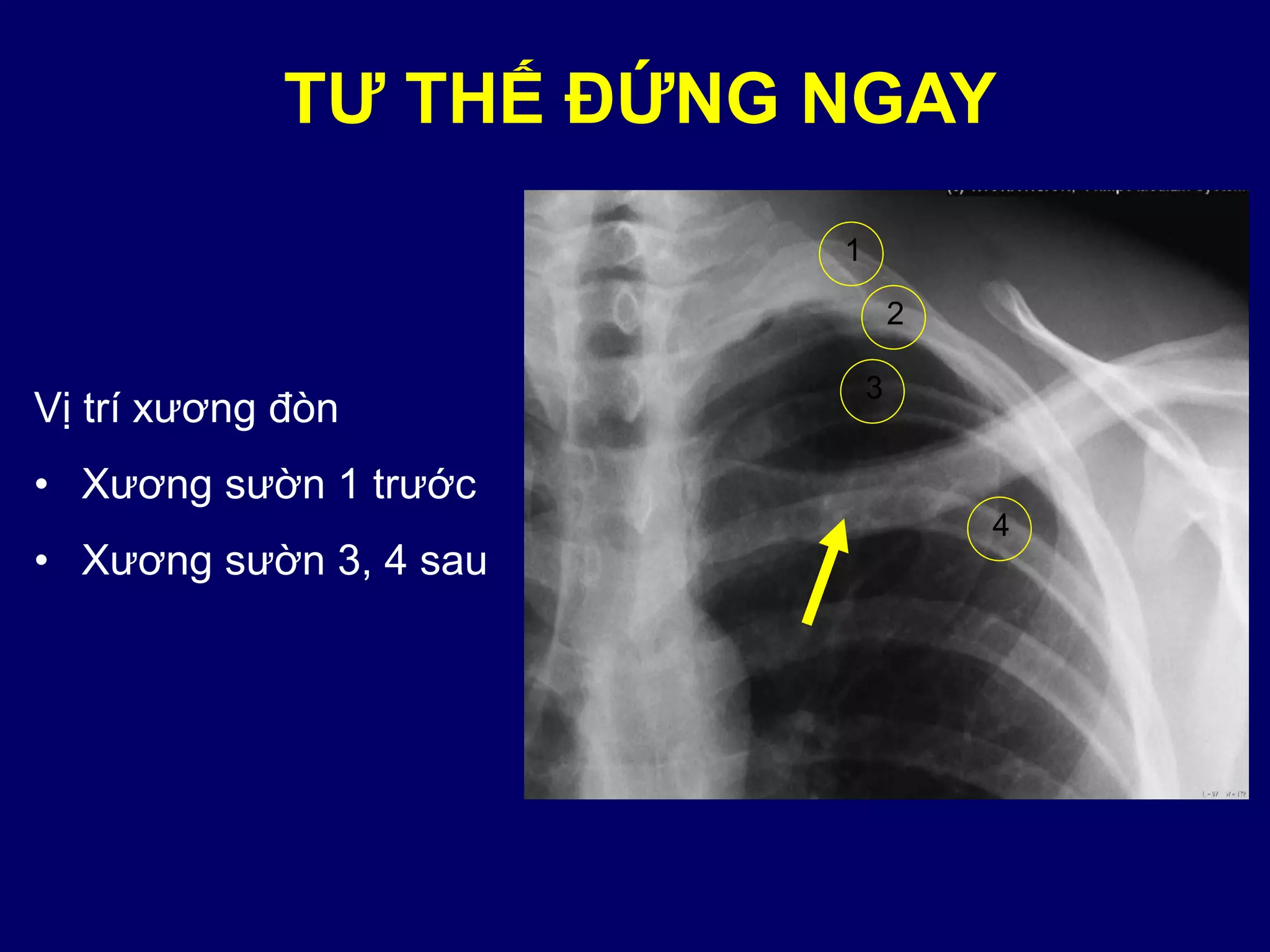 PHÂN TÍCH HÌNH ẢNH X QUANG LỒNG NGỰC | PDF