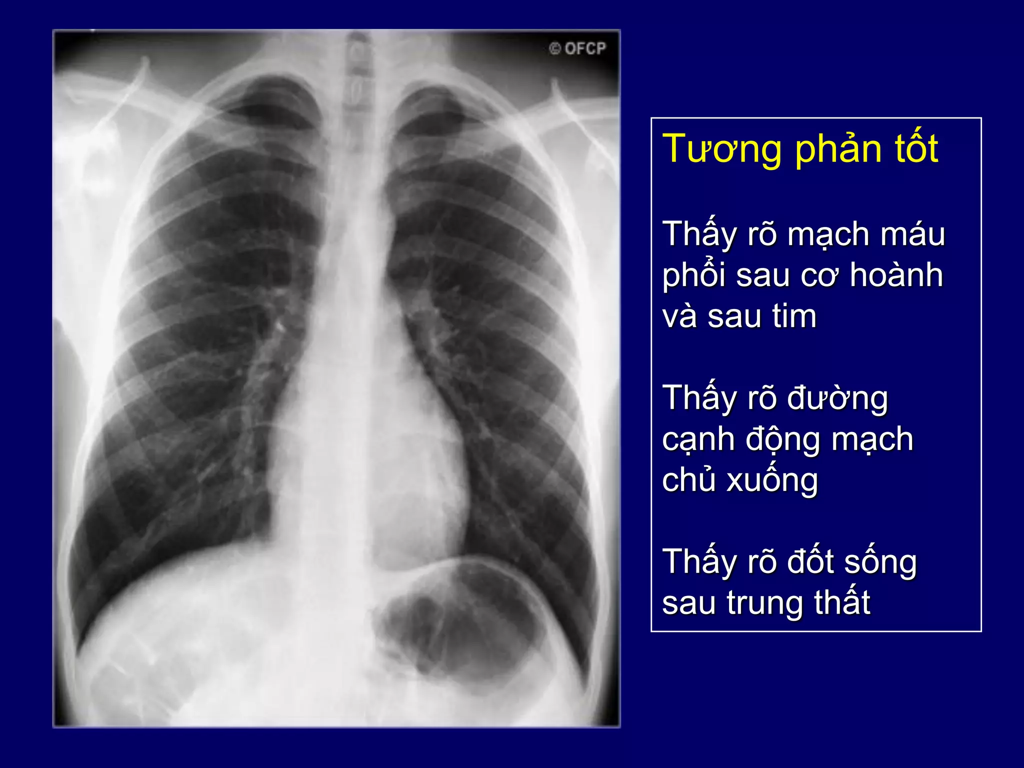 PHÂN TÍCH HÌNH ẢNH X QUANG LỒNG NGỰC | PDF