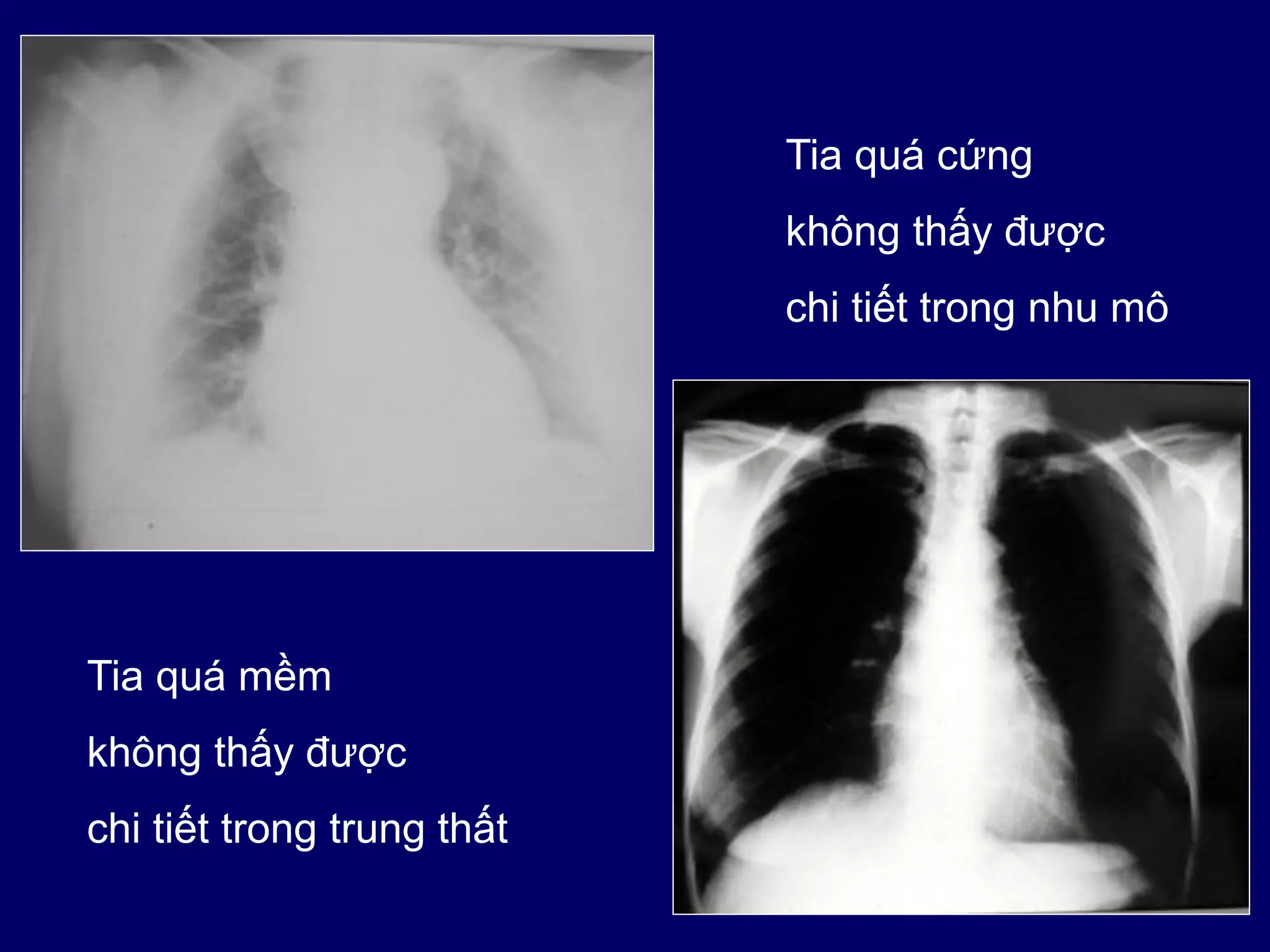 PHÂN TÍCH HÌNH ẢNH X QUANG LỒNG NGỰC | PDF