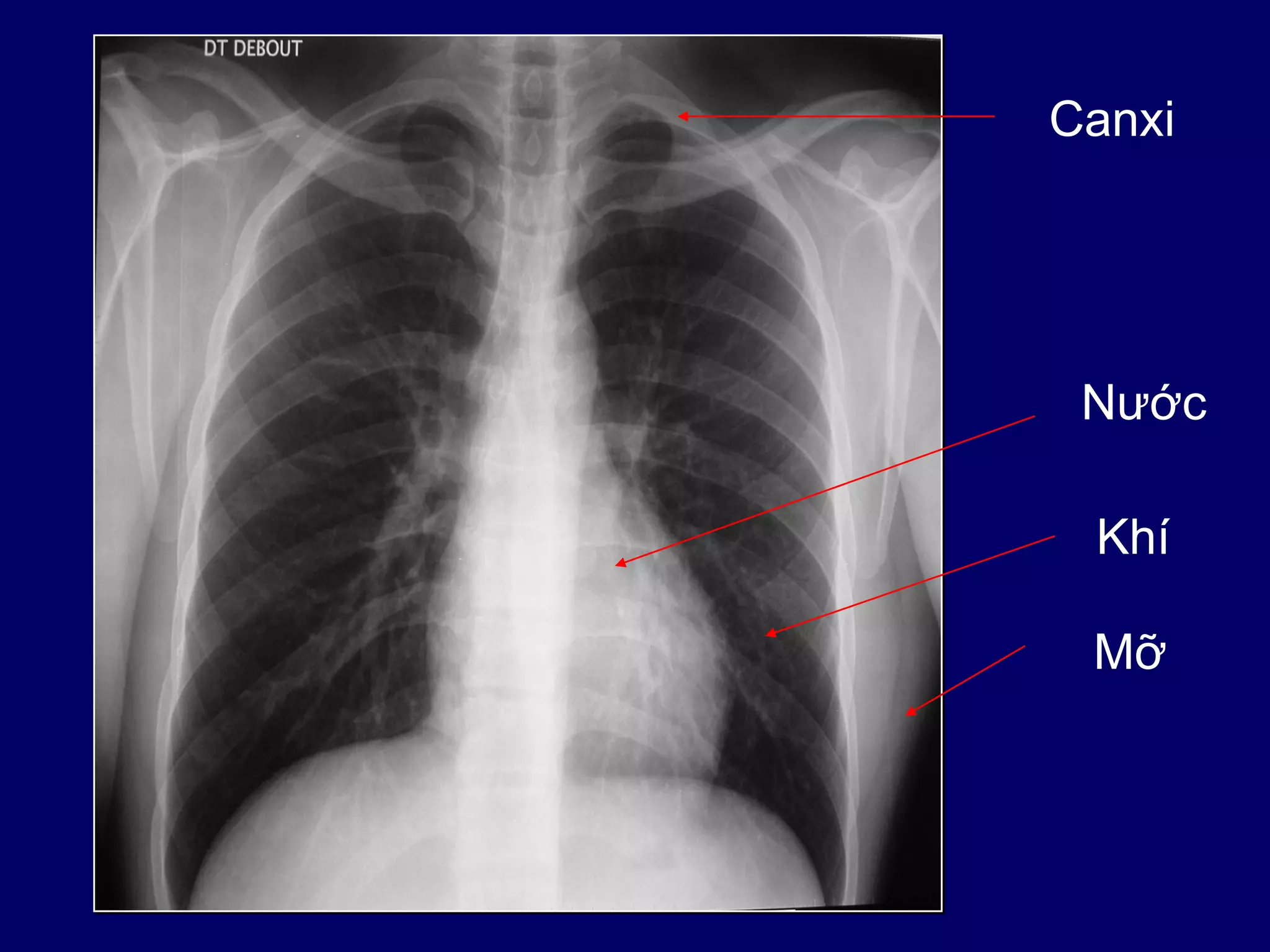 PHÂN TÍCH HÌNH ẢNH X QUANG LỒNG NGỰC | PDF