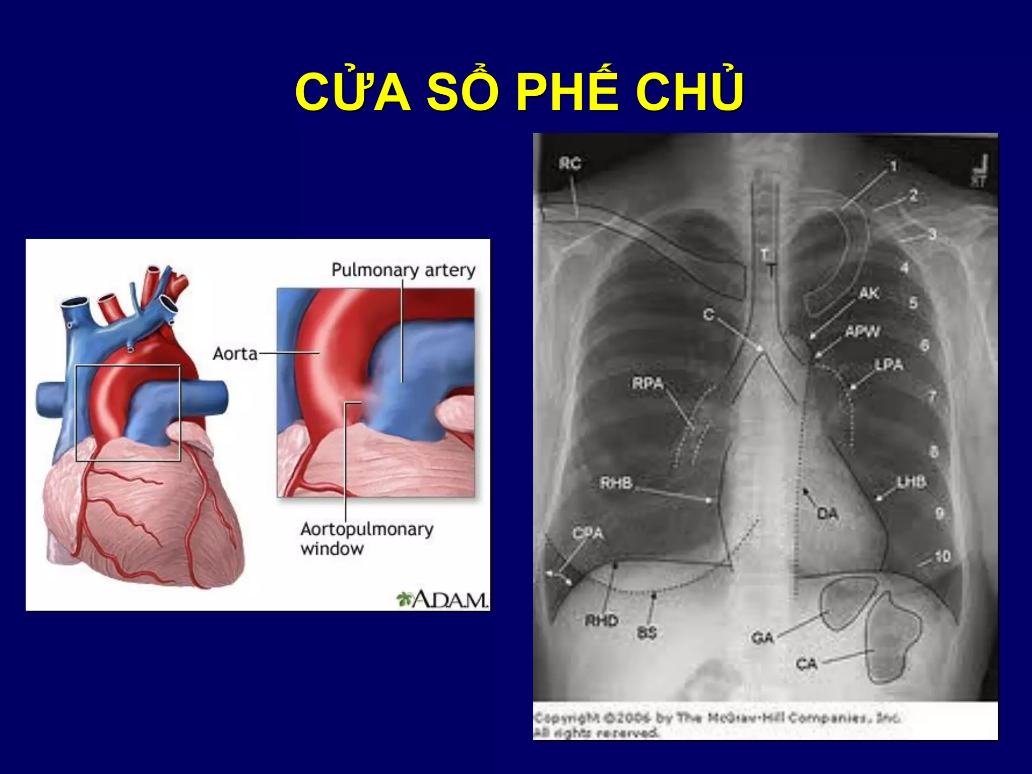 PHÂN TÍCH HÌNH ẢNH X QUANG LỒNG NGỰC | PDF