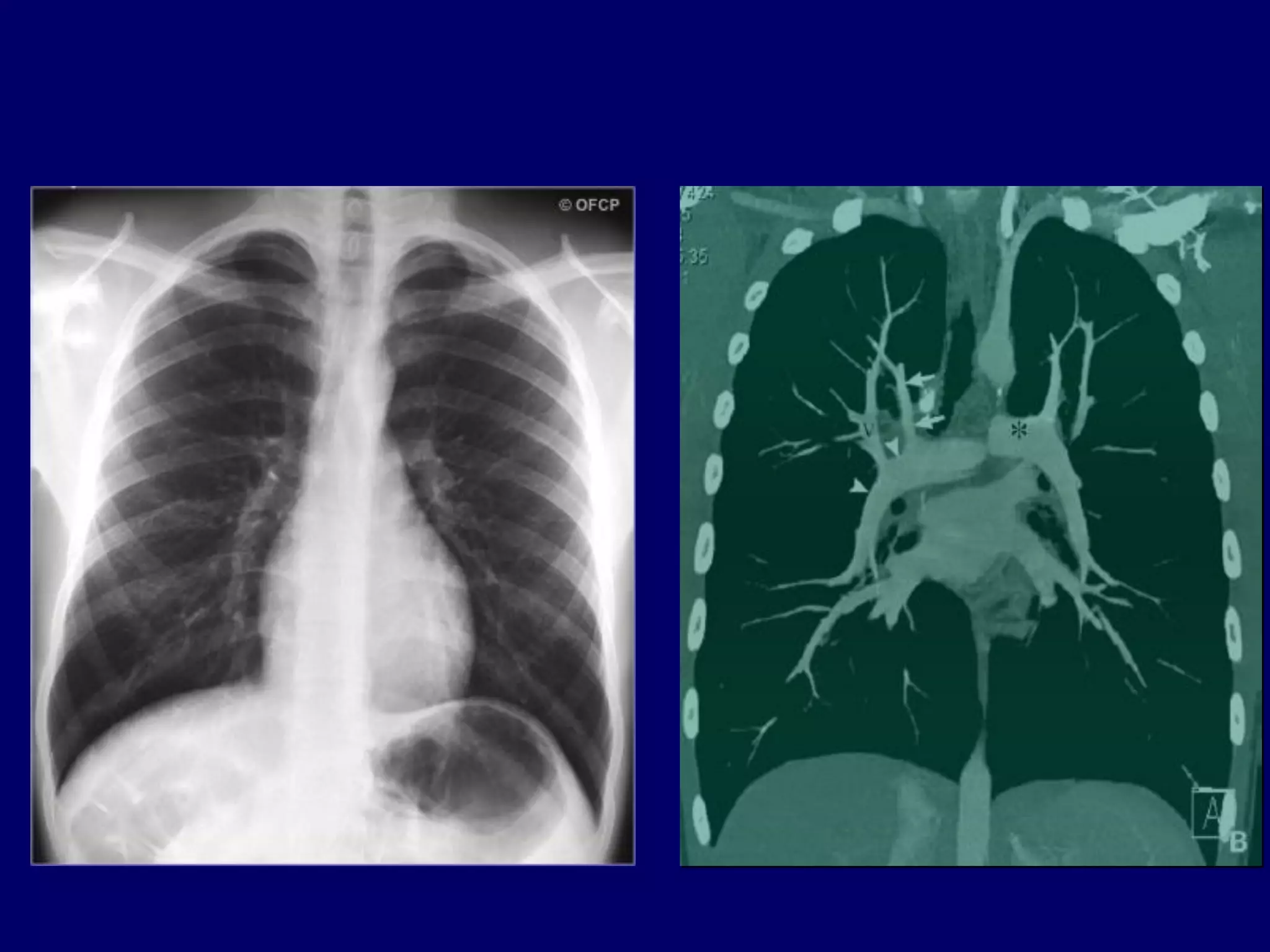 PHÂN TÍCH HÌNH ẢNH X QUANG LỒNG NGỰC | PDF