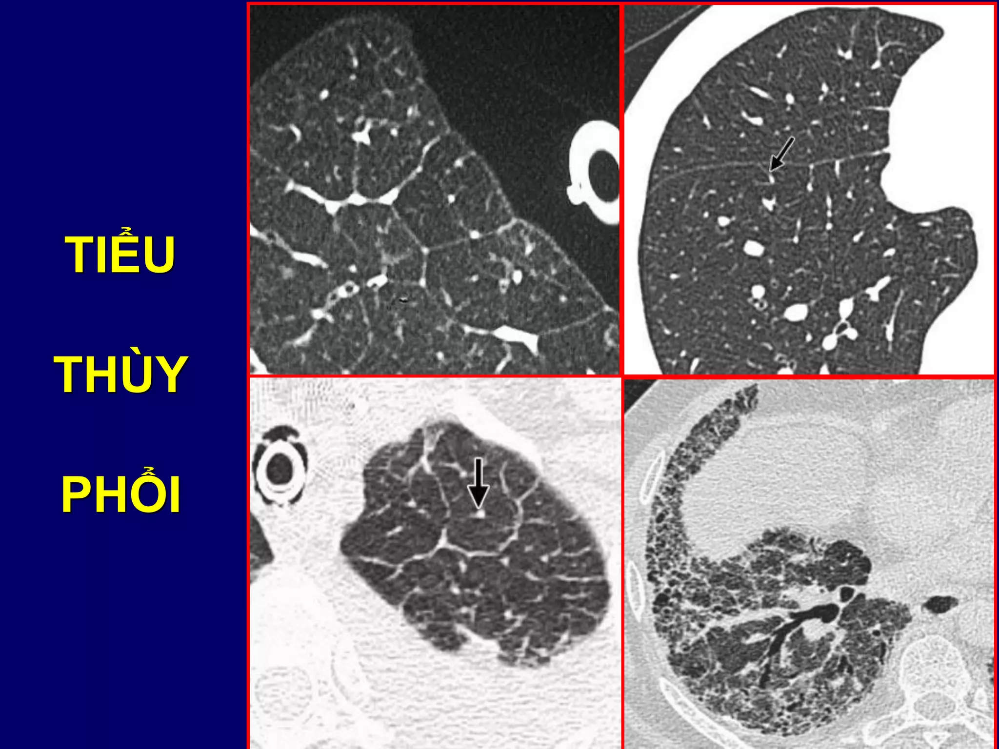 PHÂN TÍCH HÌNH ẢNH X QUANG LỒNG NGỰC | PDF