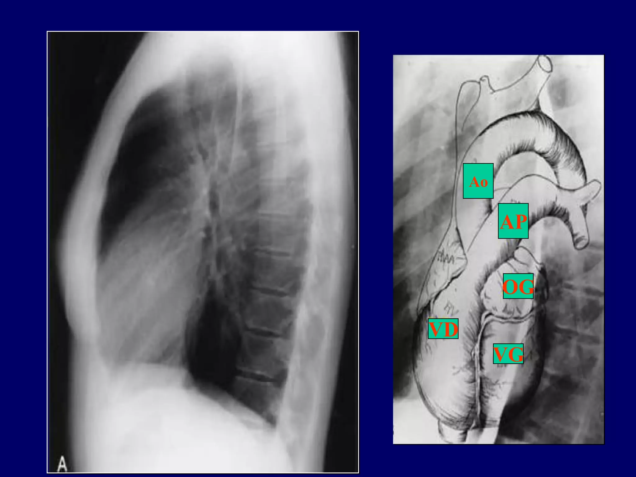 PHÂN TÍCH HÌNH ẢNH X QUANG LỒNG NGỰC | PDF