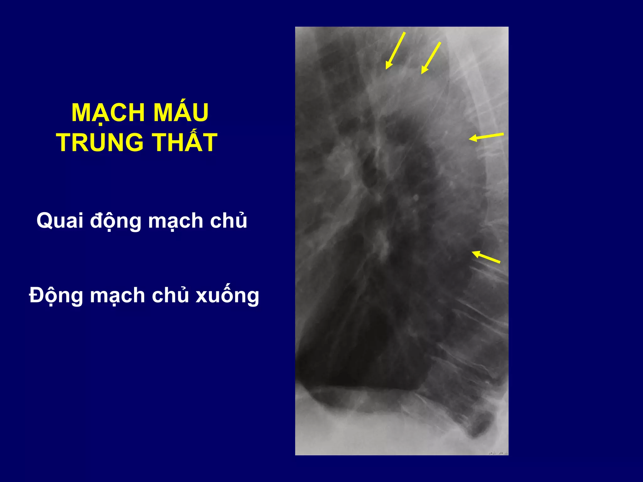 PHÂN TÍCH HÌNH ẢNH X QUANG LỒNG NGỰC | PDF