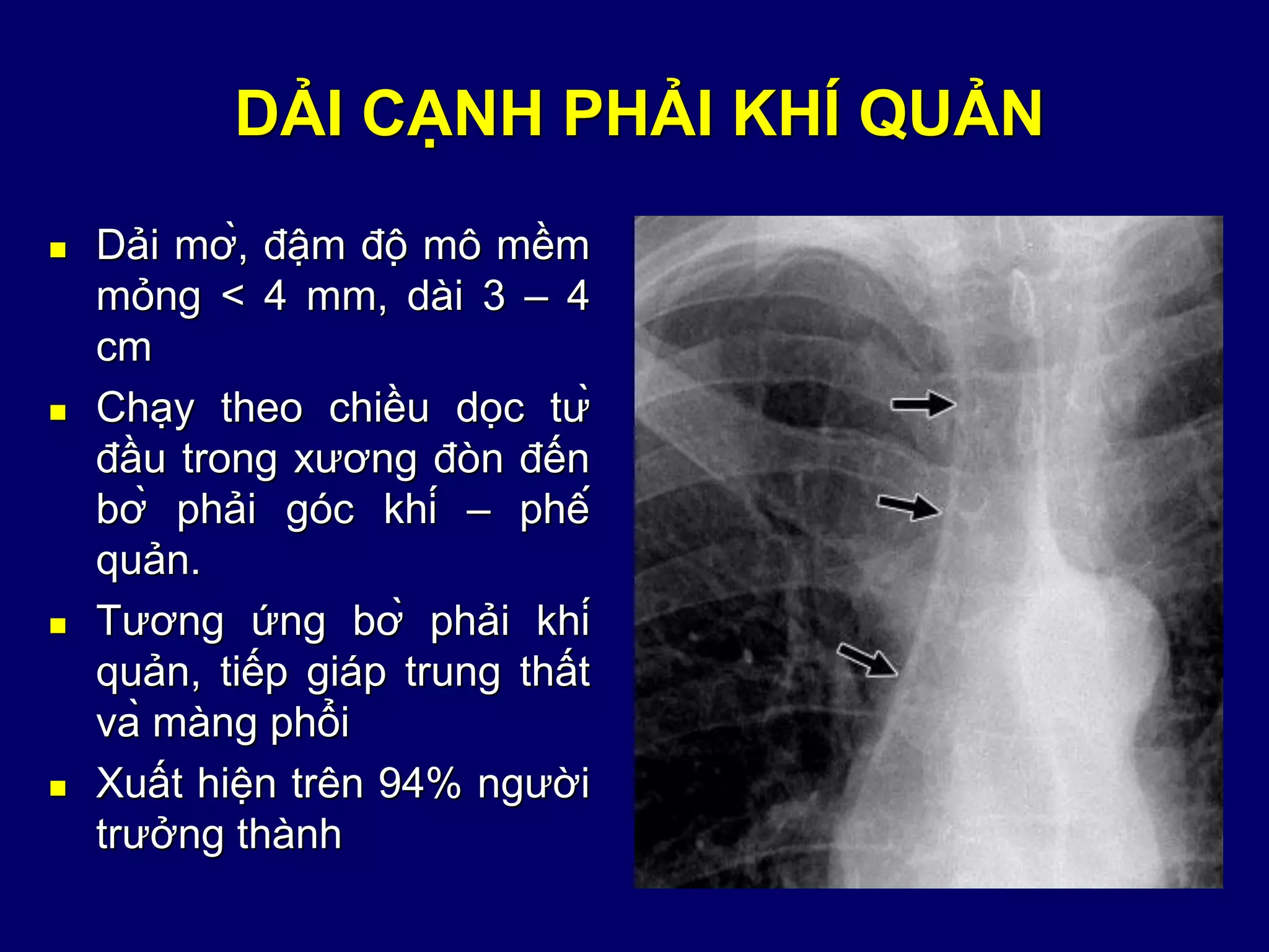 PHÂN TÍCH HÌNH ẢNH X QUANG LỒNG NGỰC | PDF
