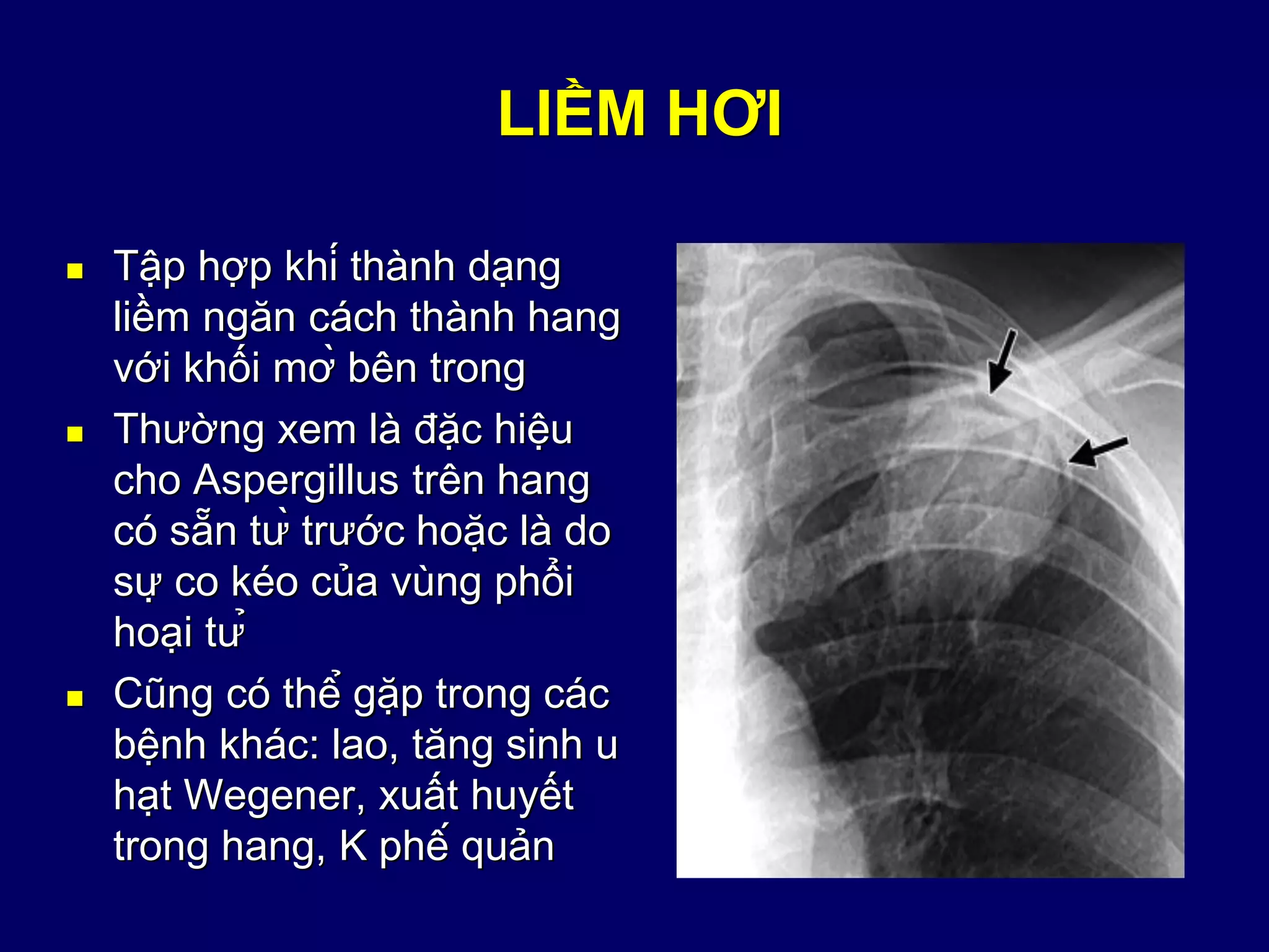 PHÂN TÍCH HÌNH ẢNH X QUANG LỒNG NGỰC | PDF