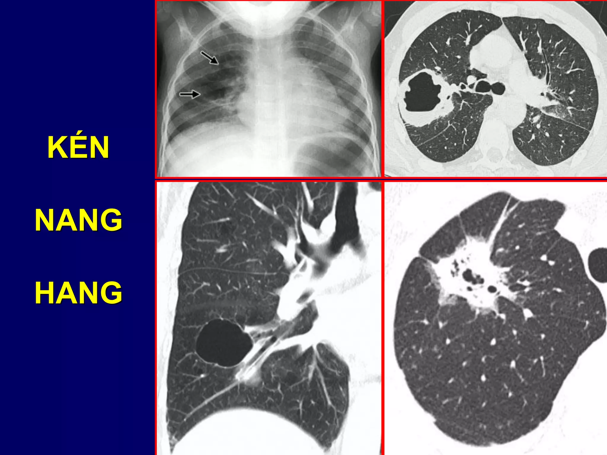 PHÂN TÍCH HÌNH ẢNH X QUANG LỒNG NGỰC | PDF