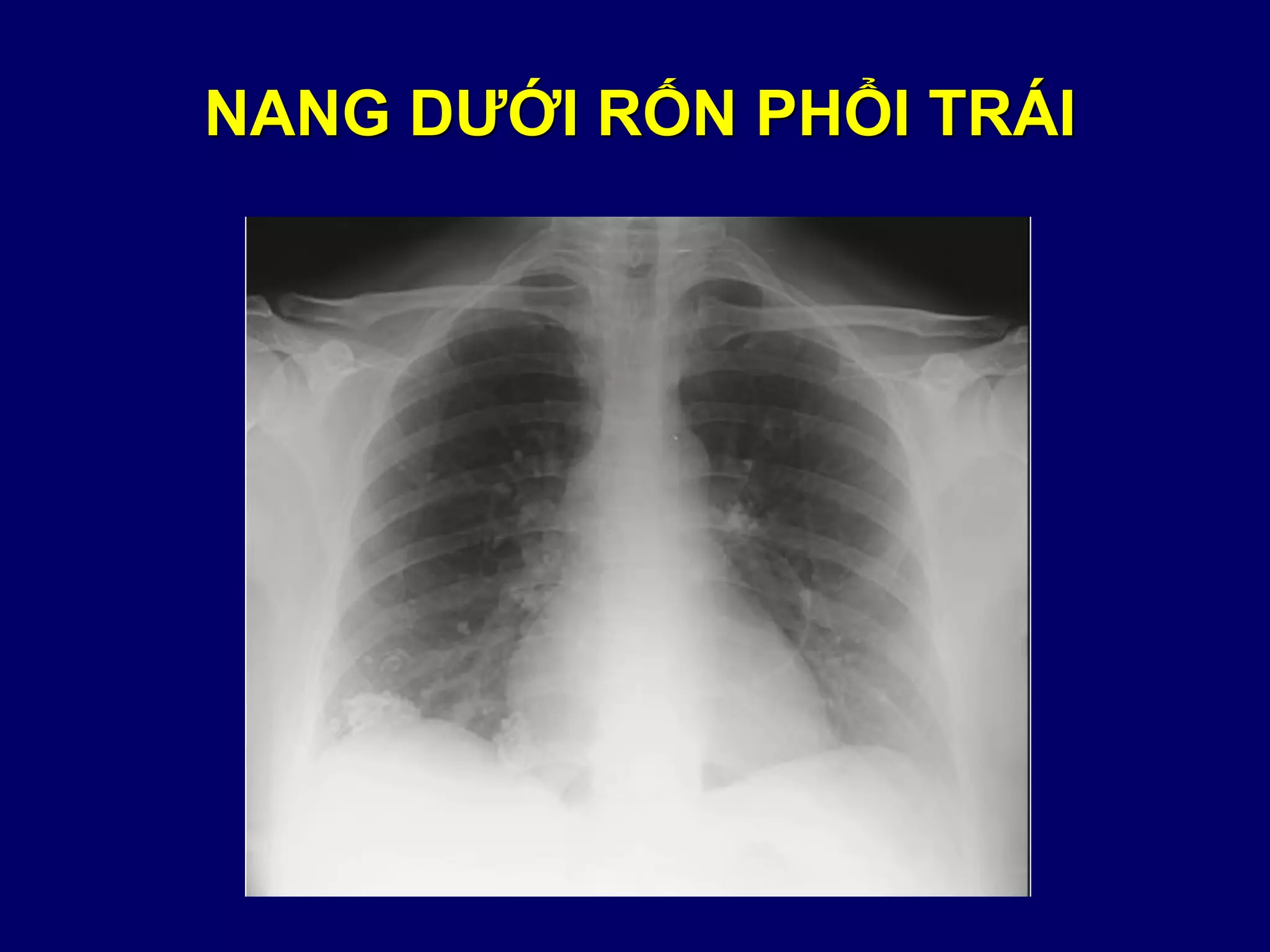PHÂN TÍCH HÌNH ẢNH X QUANG LỒNG NGỰC | PDF