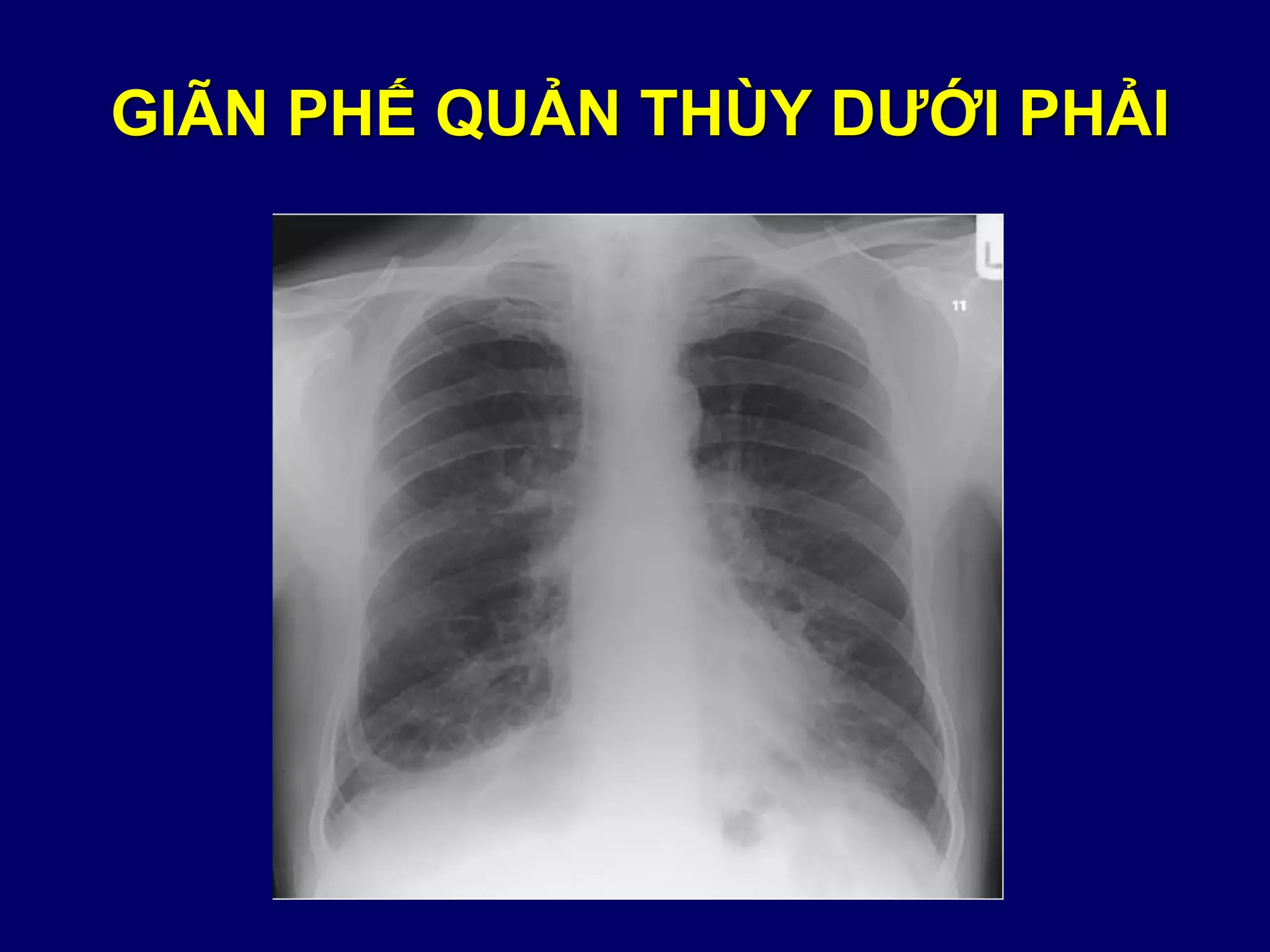 PHÂN TÍCH HÌNH ẢNH X QUANG LỒNG NGỰC | PDF