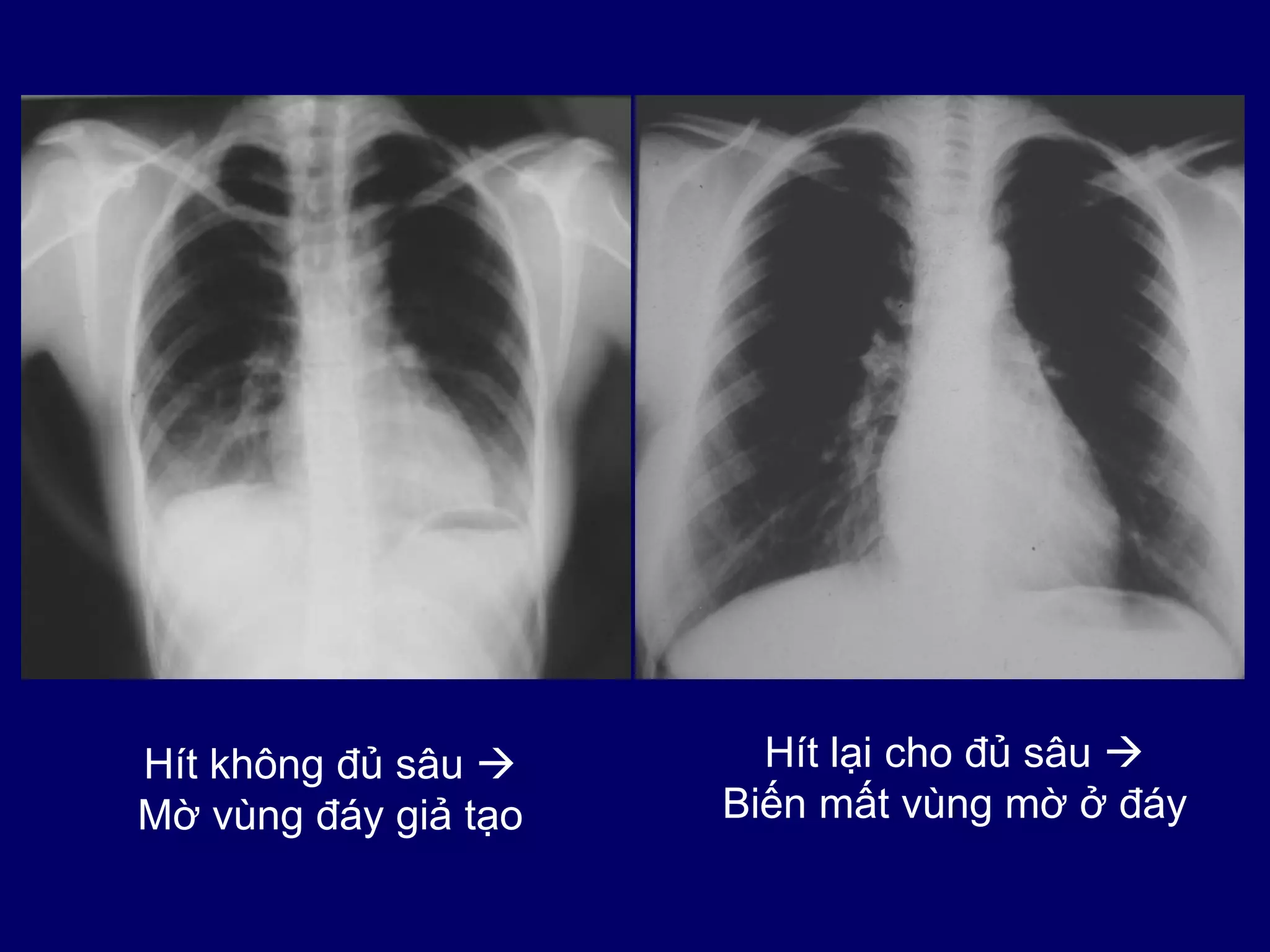 PHÂN TÍCH HÌNH ẢNH X QUANG LỒNG NGỰC | PDF