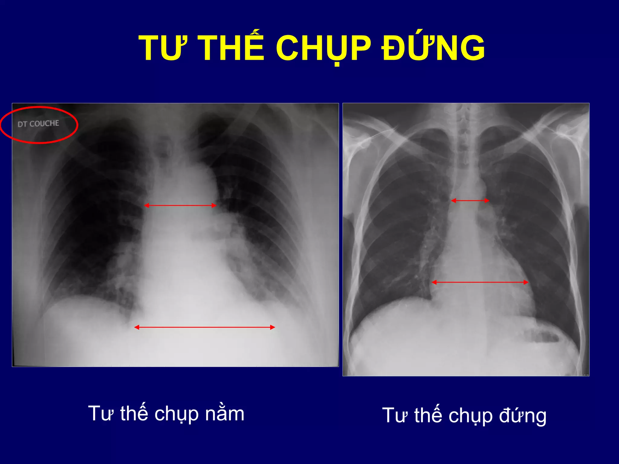 PHÂN TÍCH HÌNH ẢNH X QUANG LỒNG NGỰC | PDF