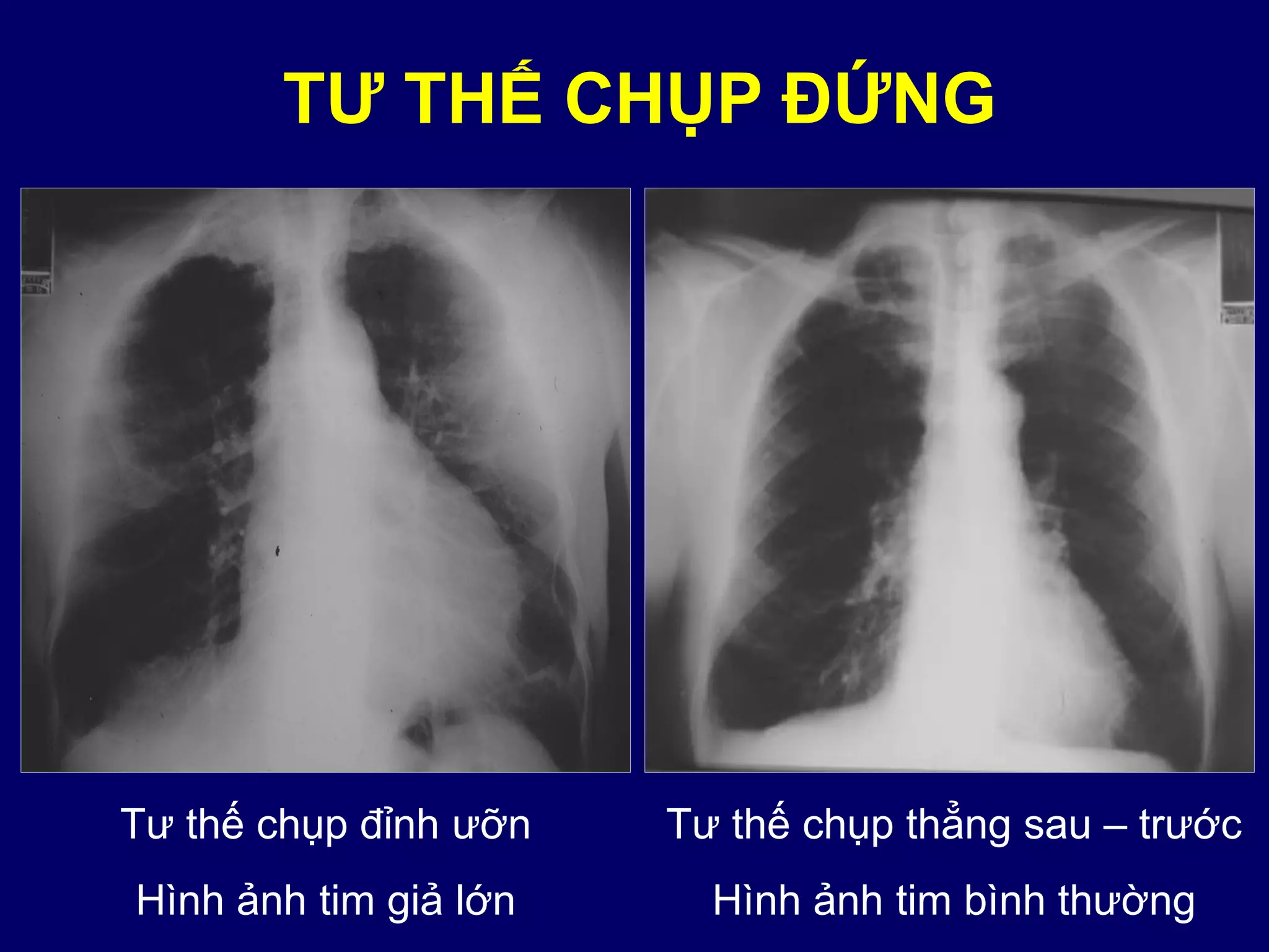 PHÂN TÍCH HÌNH ẢNH X QUANG LỒNG NGỰC | PDF