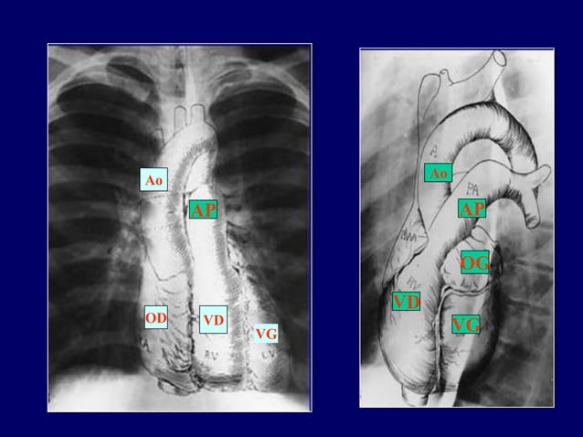 PHÂN TÍCH HÌNH ẢNH X QUANG LỒNG NGỰC | PDF
