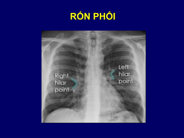PHÂN TÍCH HÌNH ẢNH X QUANG LỒNG NGỰC | PDF