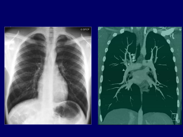 PHÂN TÍCH HÌNH ẢNH X QUANG LỒNG NGỰC | PDF