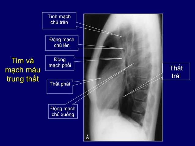 PHÂN TÍCH HÌNH ẢNH X QUANG LỒNG NGỰC | PDF