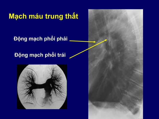 PHÂN TÍCH HÌNH ẢNH X QUANG LỒNG NGỰC | PDF