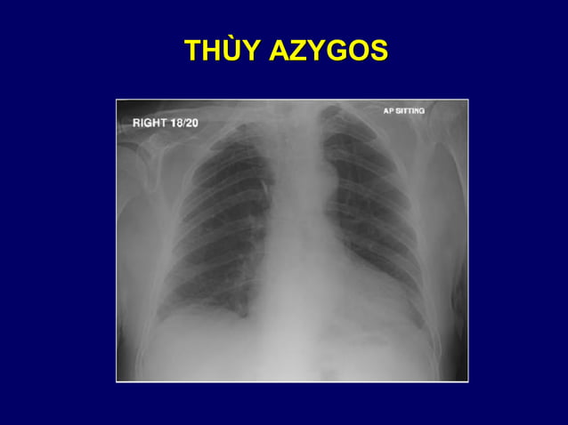 PHÂN TÍCH HÌNH ẢNH X QUANG LỒNG NGỰC | PDF