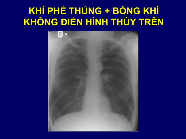 PHÂN TÍCH HÌNH ẢNH X QUANG LỒNG NGỰC | PDF