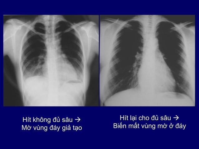 PHÂN TÍCH HÌNH ẢNH X QUANG LỒNG NGỰC | PDF