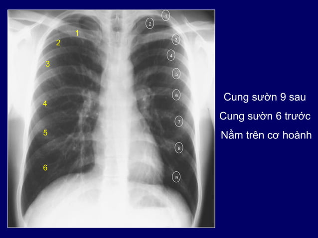 PHÂN TÍCH HÌNH ẢNH X QUANG LỒNG NGỰC | PDF