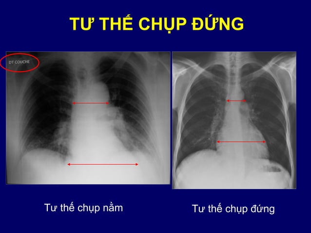 PHÂN TÍCH HÌNH ẢNH X QUANG LỒNG NGỰC | PDF