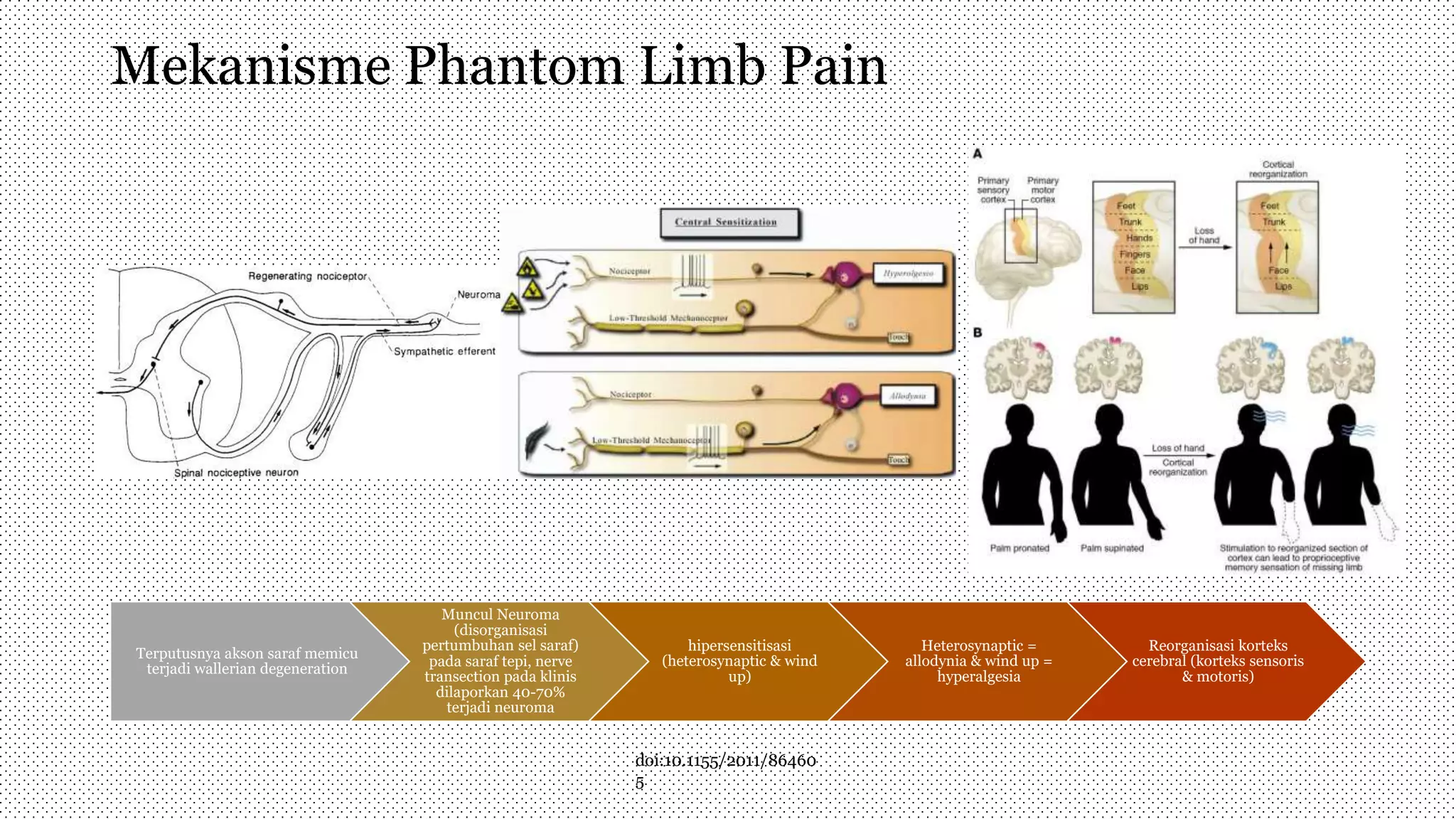 Phantom Limb Pain.pptx