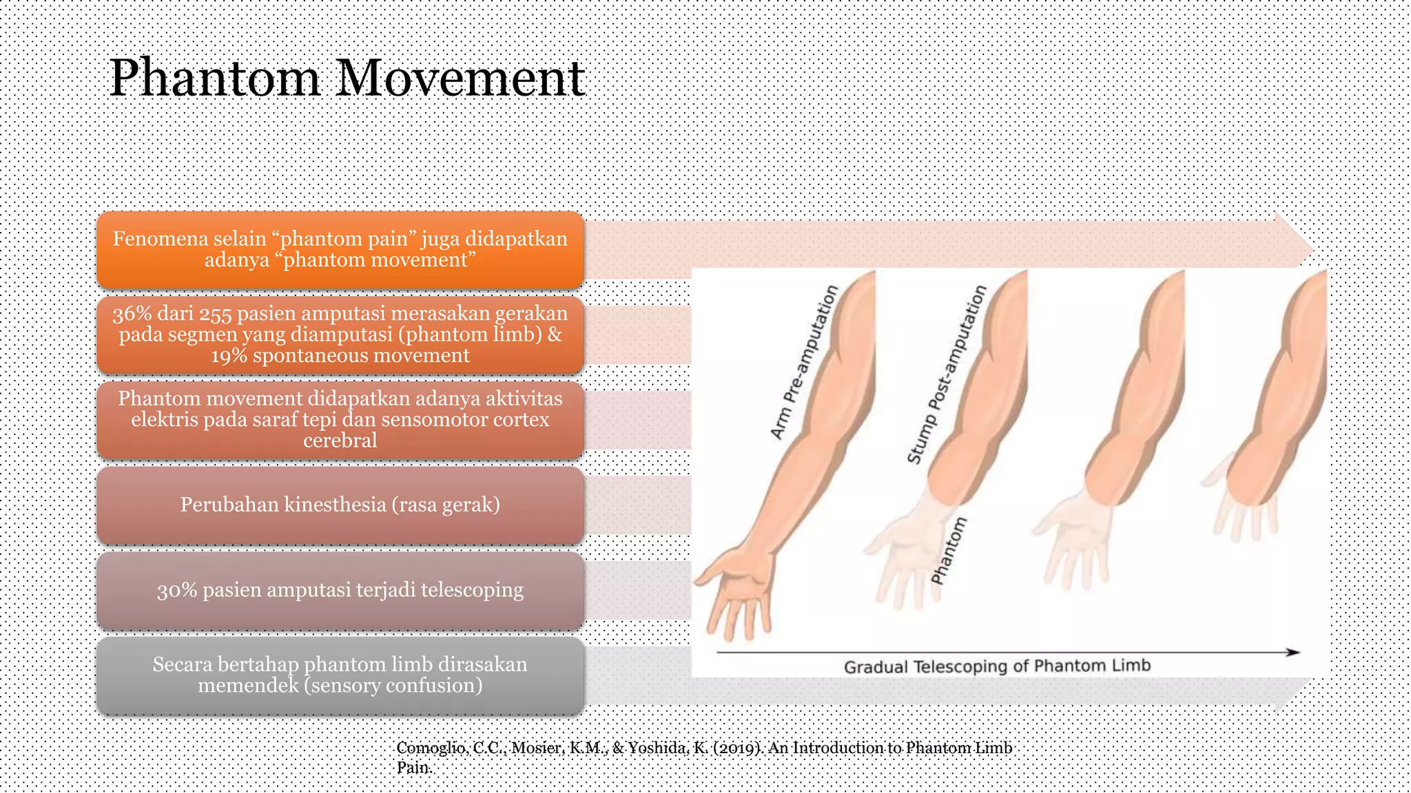 Phantom Limb Pain.pptx