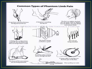 Phantom pain & sensation 1 | PPTX