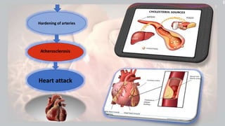Stress with Heart Attack | PPTX