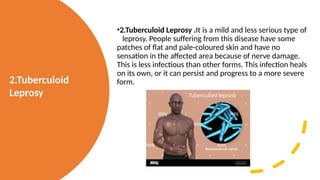 Explain leprosy disease such as definition | PPT