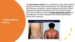 Explain leprosy disease such as definition | PPT