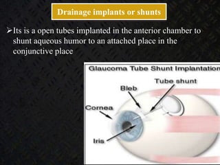 Pharmacotherapy of glaucoma | PPTX