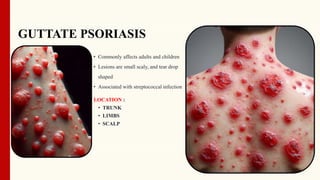 PHARMACOTHERAPY AND FUTURE PROSPECTS OF PSORIASIS.pptx