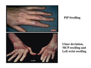 PHARMACOTHERAPY OF RHEUMATOID ARTHRITIS- BY DR. ANURAG SHARMA.pptx