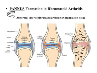 PHARMACOTHERAPY OF RHEUMATOID ARTHRITIS- BY DR. ANURAG SHARMA.pptx