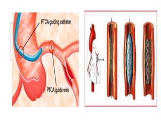 Pharmacotherapy of stable angina | PPTX