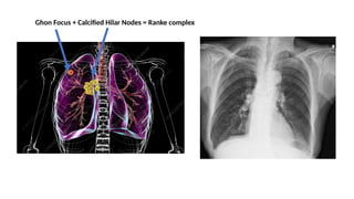 Pharmacotherapy of Pulmonary Tuberculosis | PPTX